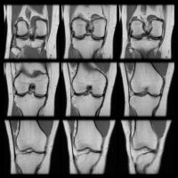 ACL Tear Diagnosis: When Do You Need a Knee MRI? - Cary Orthopaedics